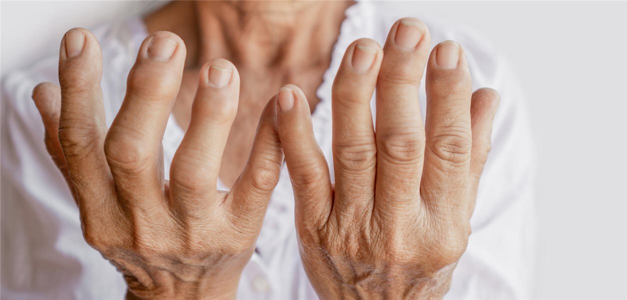 Gicht: Das ist bei der medikamentösen Harnsäuresenkung wichtig