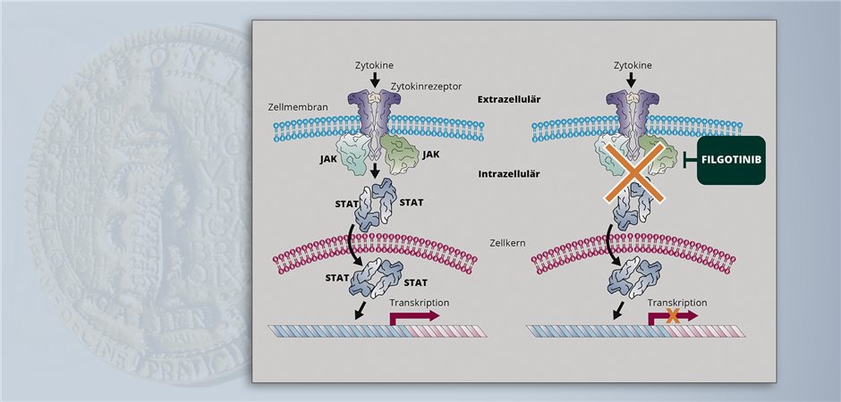 Jyseleca: präferenzielle JAK1-Hemmung bei vorbehandelter Colitis ulcerosa