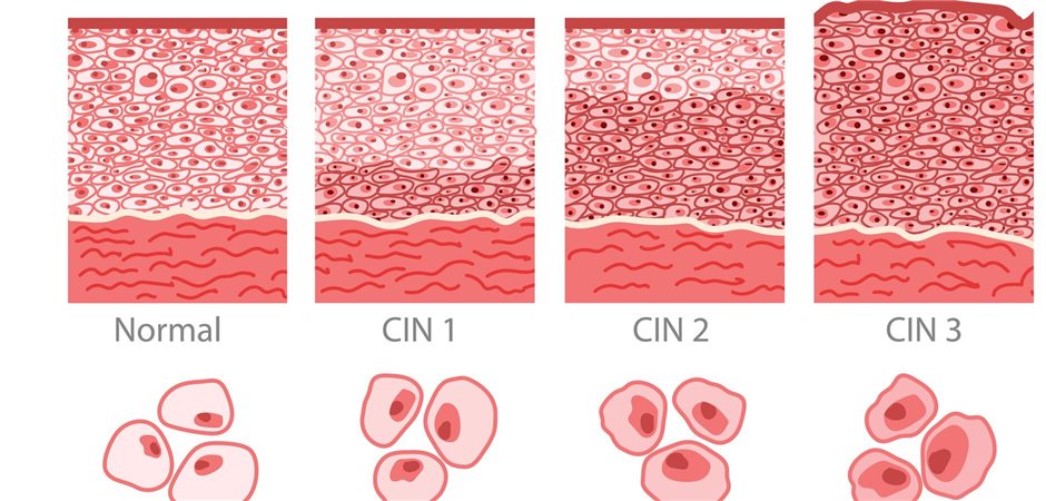 Langzeitrisiko für Zervixkrebs wohl nach aktiver Überwachung von CIN2 ...