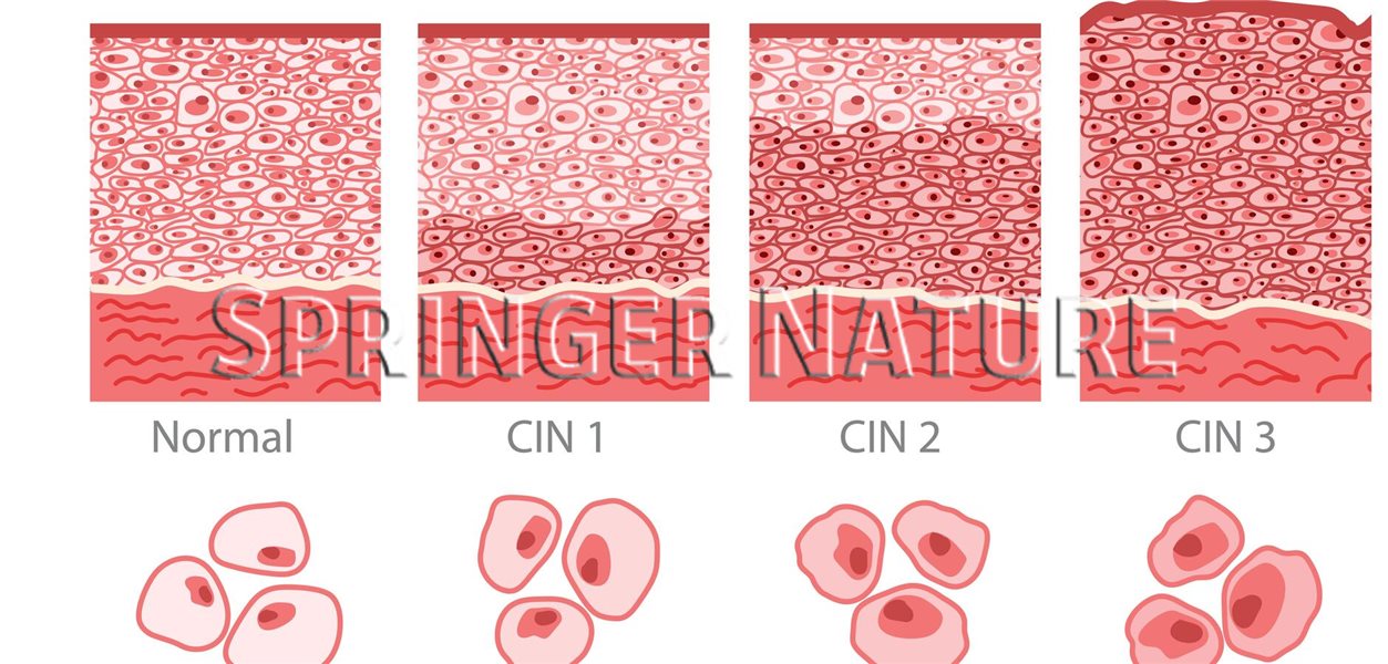 Langzeitrisiko für Zervixkrebs wohl nach aktiver Überwachung von CIN2 ...