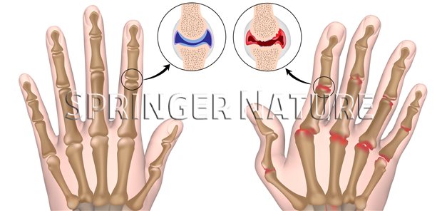 Neuer Wirkstoff gegen Rheumatoide Arthritis bewährt sich