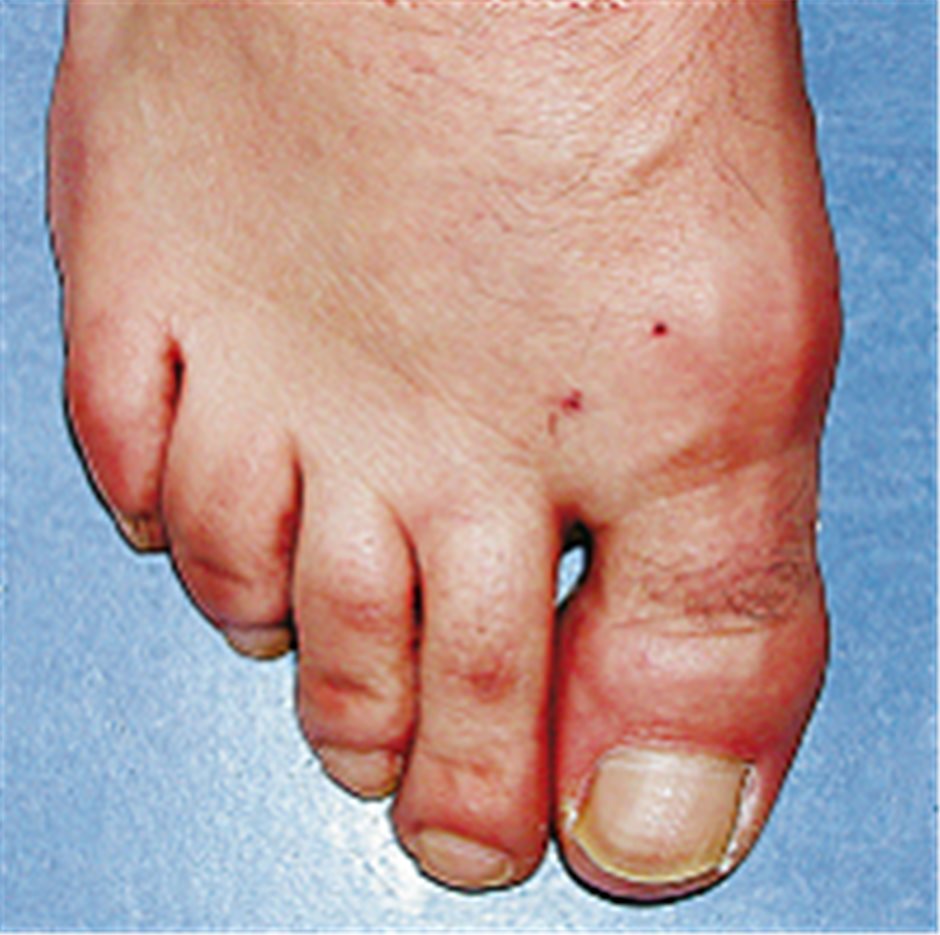 Was tun, wenn die Gicht nicht geht? - Eine Checkliste gibt Ärzten ...