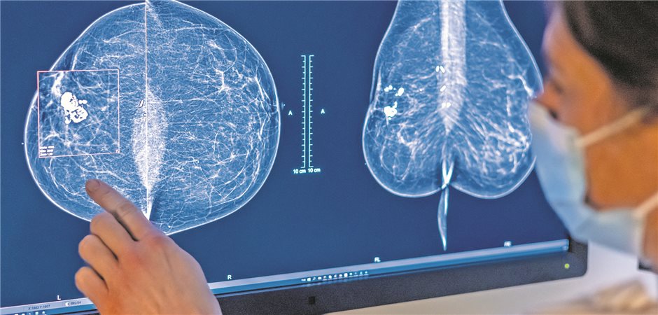 Mit Tomosynthese Mamma-Ca bei dichtem Gewebe besser erkennen