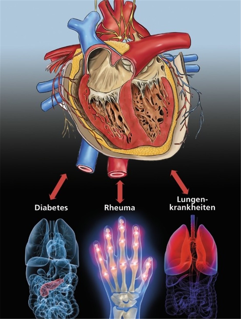 Rheuma und Herzerkrankung Hand in Hand