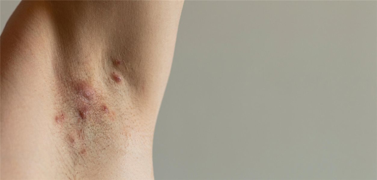 Entzündete Talgdrüsen bei Adipositas: Neuer Job für GLP-1-Agonisten?