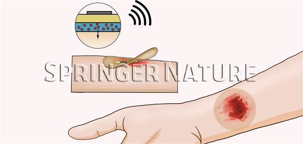 Mit intelligentem Verband heilen chronische Wunden besser ab