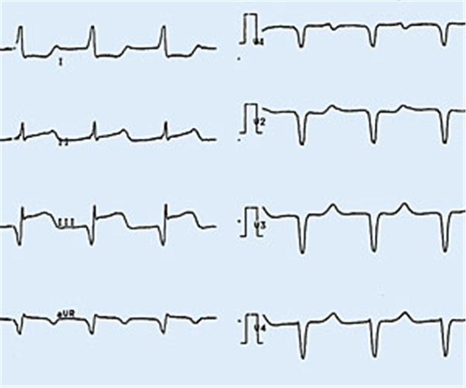 Neuer Stent senkt Komplikationsrate nach Infarkt