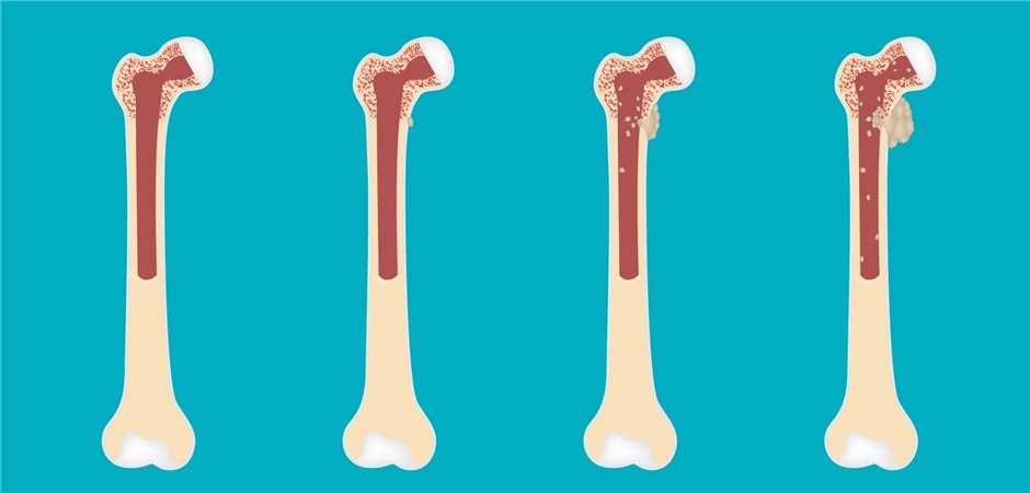 Ewing-Sarkom: Taugt das Protein TCF7L1 als Prognosemarker?