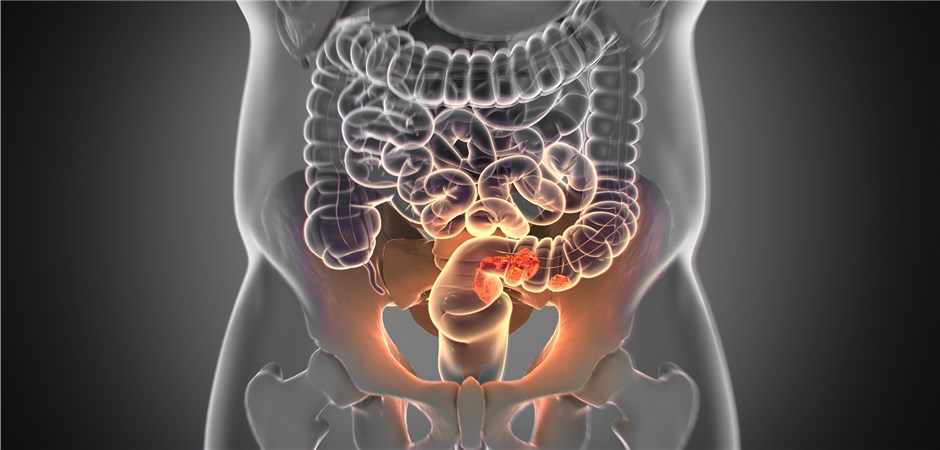 Metastasiertes Kolonkarzinom: Lieber „Hit Hard“ als „Go Slow“