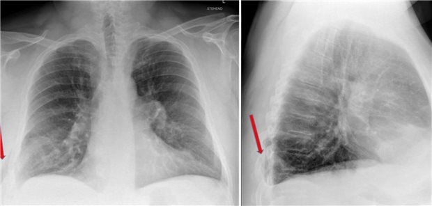 Laterale Lungenhernie: Vom Husten buchstäblich zerrissen