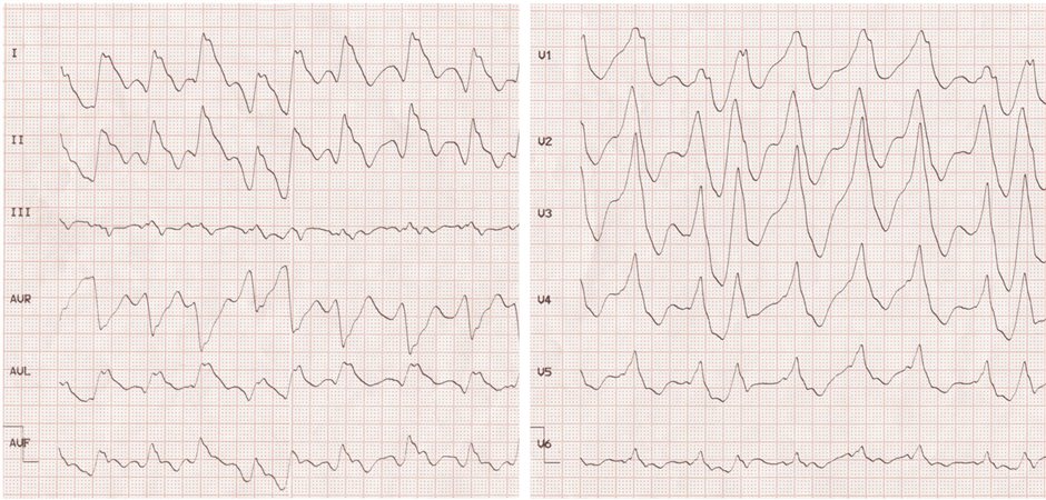 Fast, Broad, Irregular: Was eine FBI-Tachykardie kennzeichnet