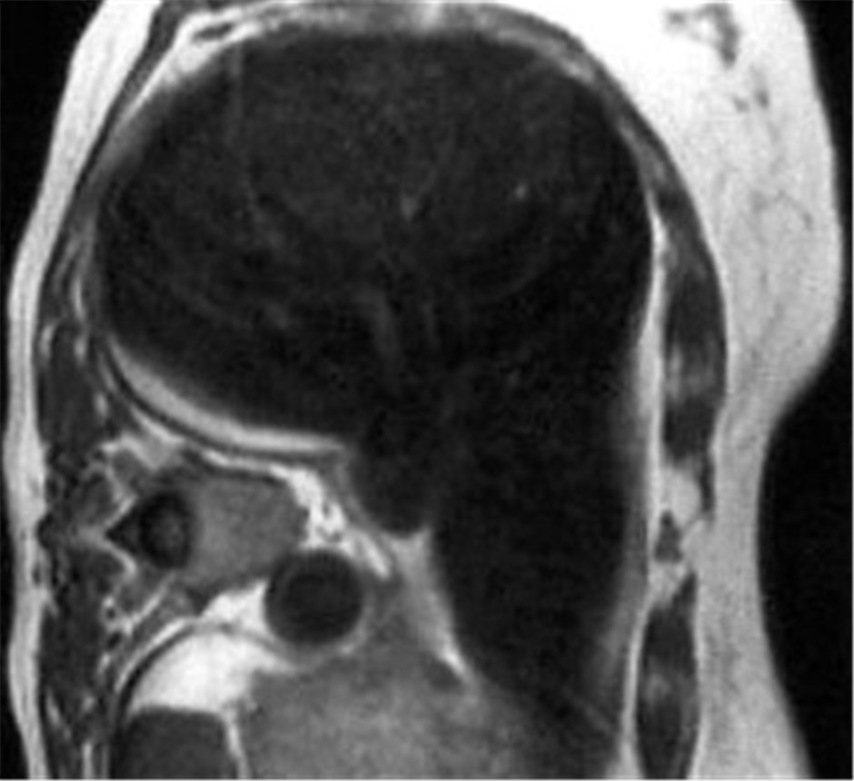 Hämochromatose - defektes Lebergen stört Darmfunktion