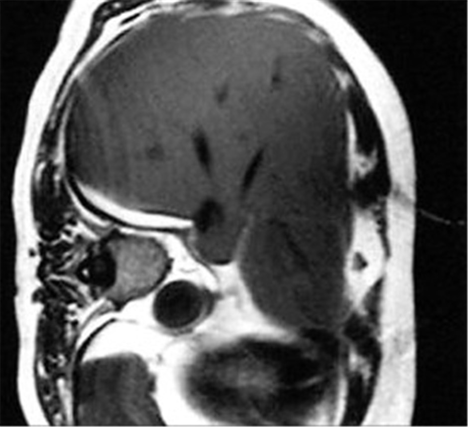 Hämochromatose - defektes Lebergen stört Darmfunktion