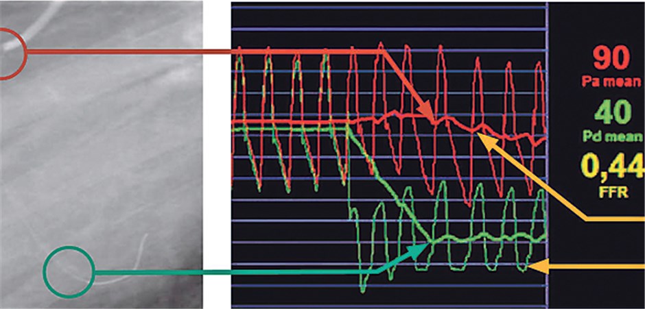 FFR-Messung: Wegweiser zur optimalen KHK-Therapie