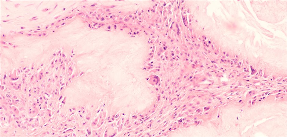 Schwellung an der Nase entpuppte sich als Gichttophus