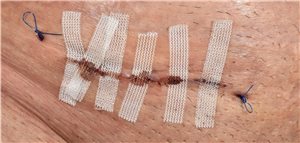 Auch Jahre nach der Bauch-Op: Auf Narbenhernien achten!