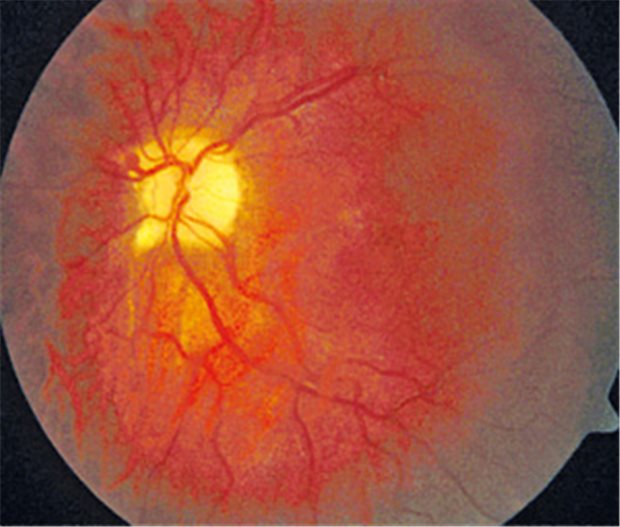 Neue Therapie für Venenverschlüsse im Auge Neue Therapie für Venenverschlüsse im Auge