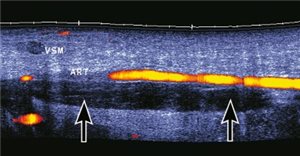Certoparin: Venenschutz auch für Bettlägerige