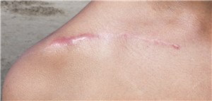 Mit Botulinumtoxin gegen Narben