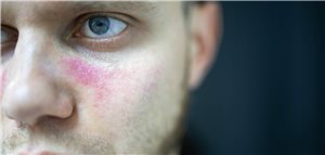 Erfolg bei CAR-T-Zelltherapie gegen Lupus