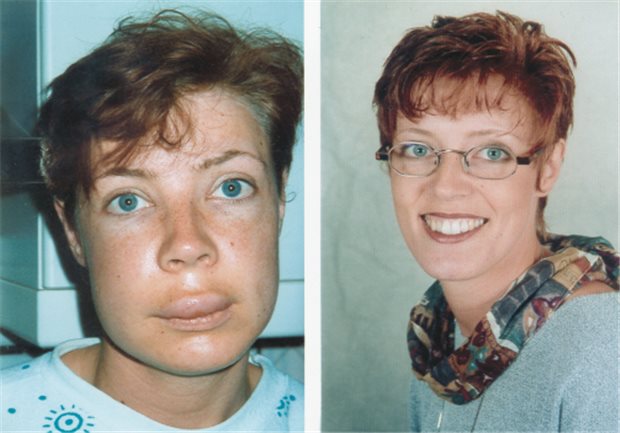 Therapie-Alternative bei Angioödem