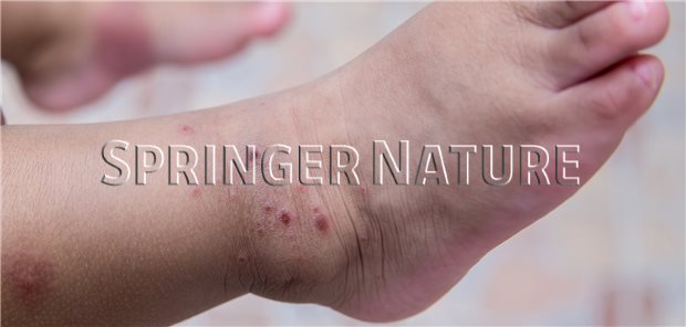 Bei Kindern: Mechanische Erklärung für Petechien zum Sepsis-Ausschluss ...