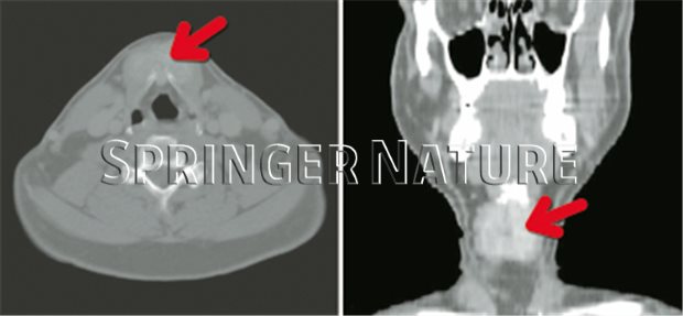 Ein Gichttumor, der sich am Schildknorpel entwickelt hat