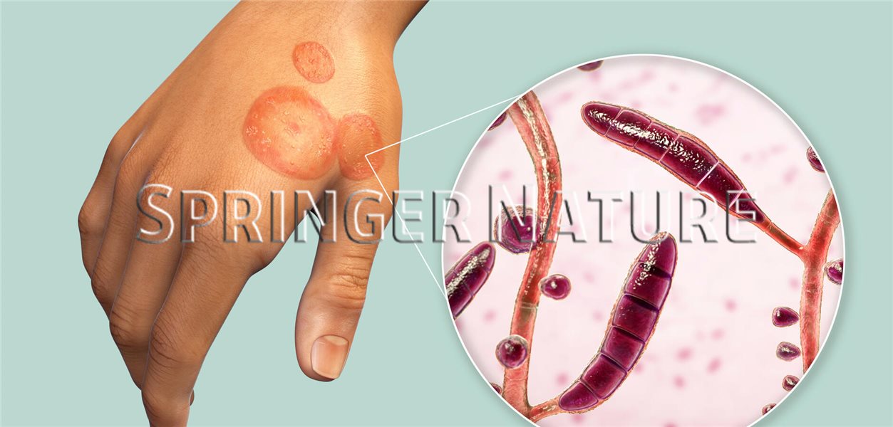 Diese „neuen“ und „alten“ Hautpilze beschäftigen die Dermatologie vermehrt