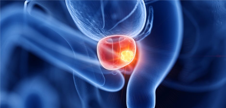 Neuer Anlauf für Prostatakrebs-Früherkennung