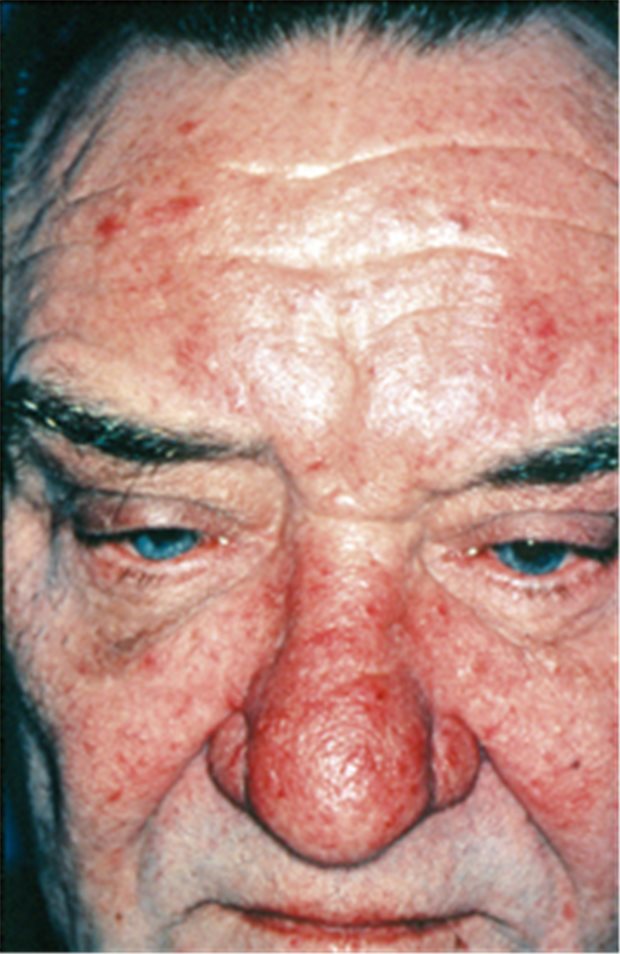 Isotretinoin bringt Läsionen bei Rosazea zum Verschwinden