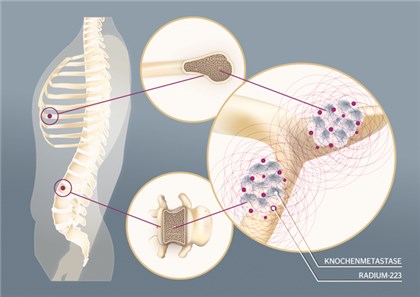 Xofigo® - gezielte Therapie gegen Knochenmetastasen bei Prostatakrebs