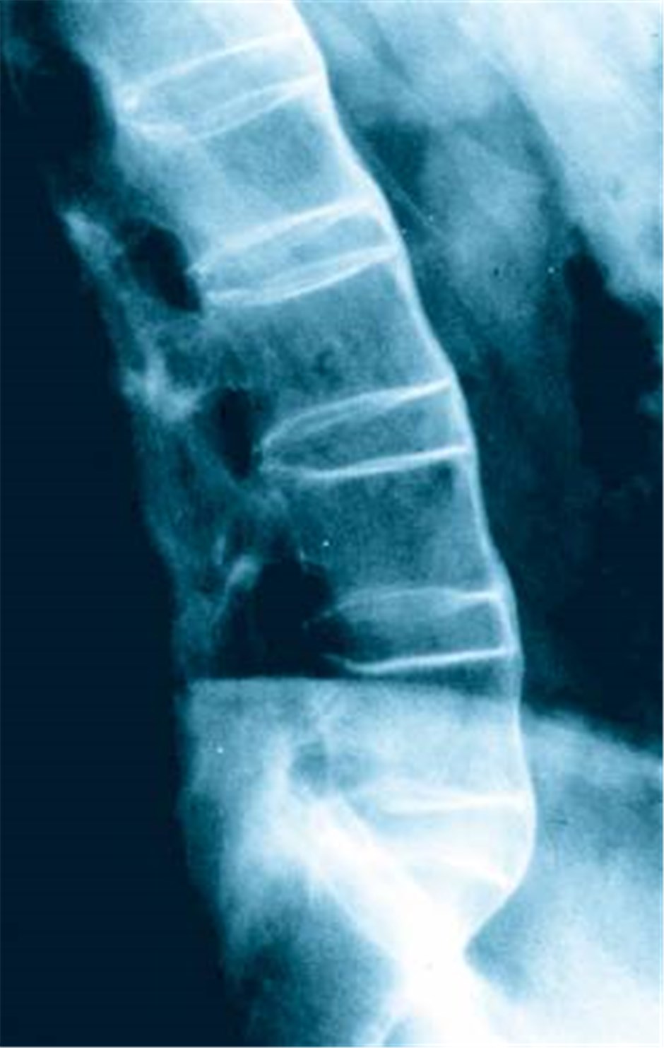 NSAR-Dauertherapie bei M. Bechterew?