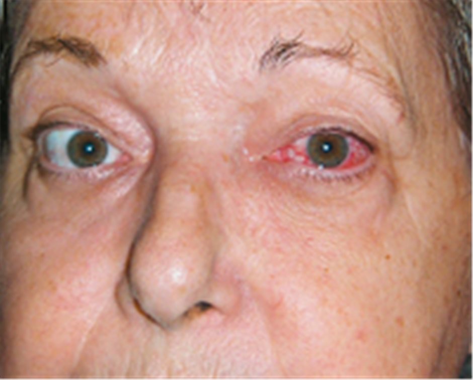 Rotes Auge nur auf einer Seite - das ist nicht immer harmlos!