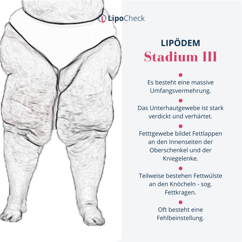 Besonderes Start-up: Lipödem-Spezialist entwickelt gemeinsam mit seinen ...