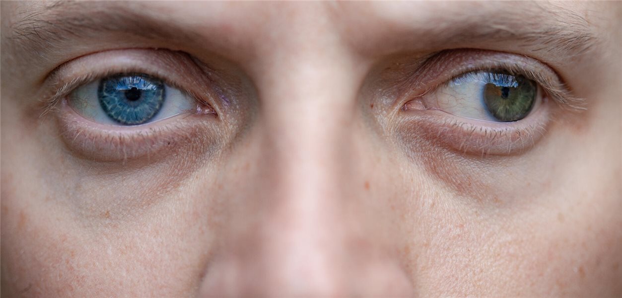 Ärzte erinnern an psychosoziale Auswirkungen des Schielens