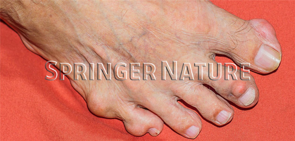 Hyperurikämie: Wann müssen erhöhte Harnsäurewerte gesenkt werden?