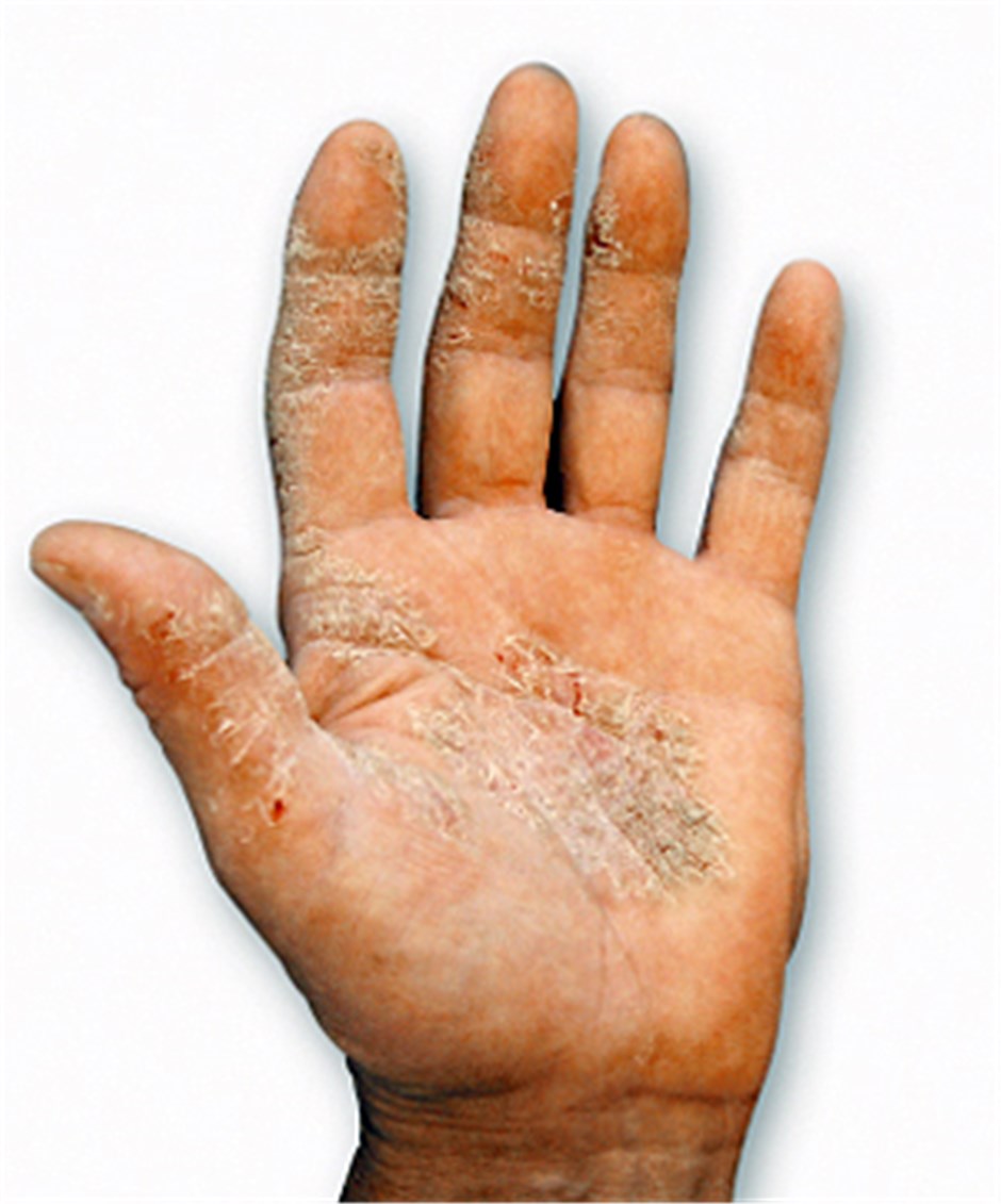 Wenn die Hände jucken und schmerzen