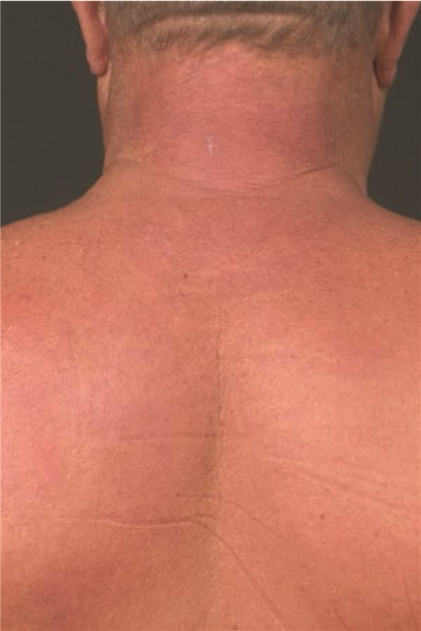 Diabetes geht meistens auch auf die Haut