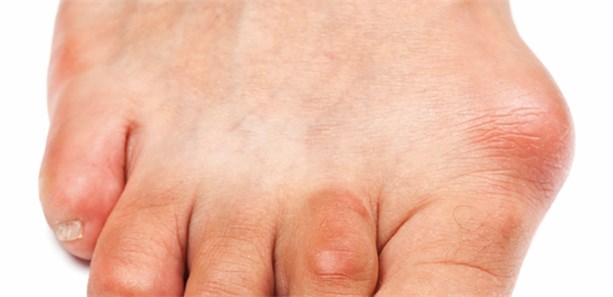 Zehn Experten-Tipps zur Gicht