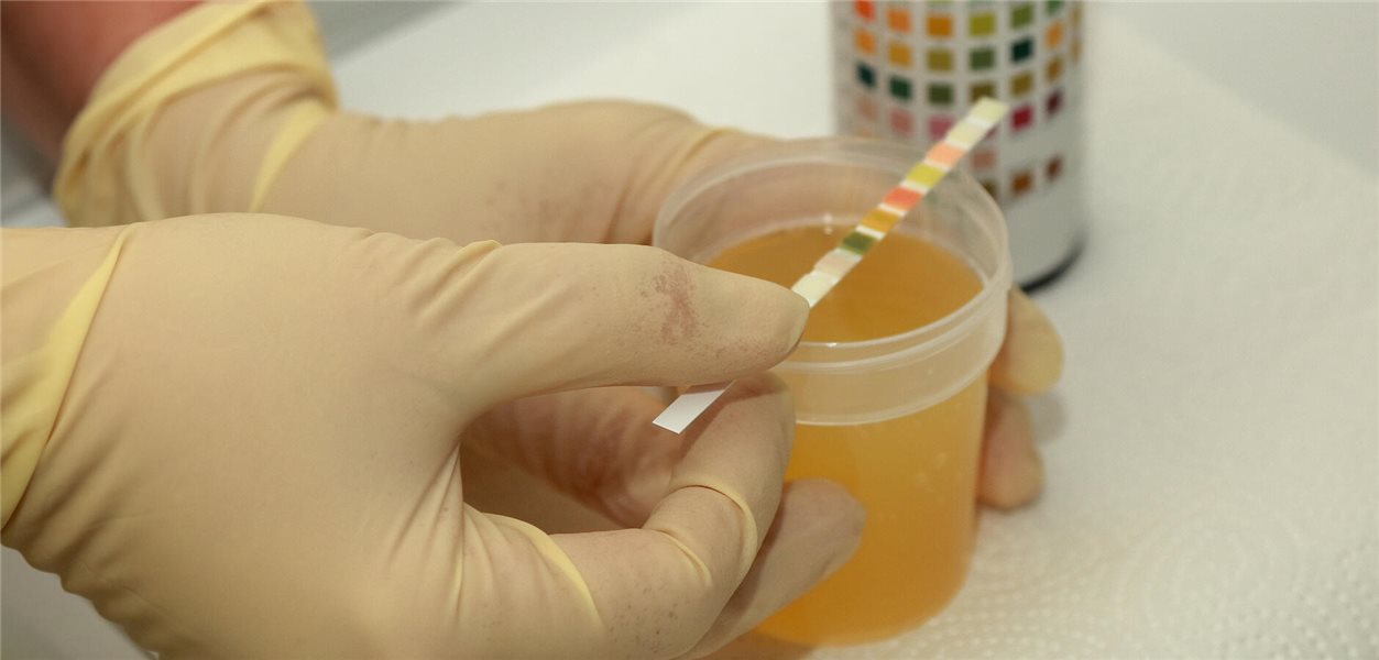 Urinteststreifen und Harnwegsinfektion: Achtung, Fallstricke!