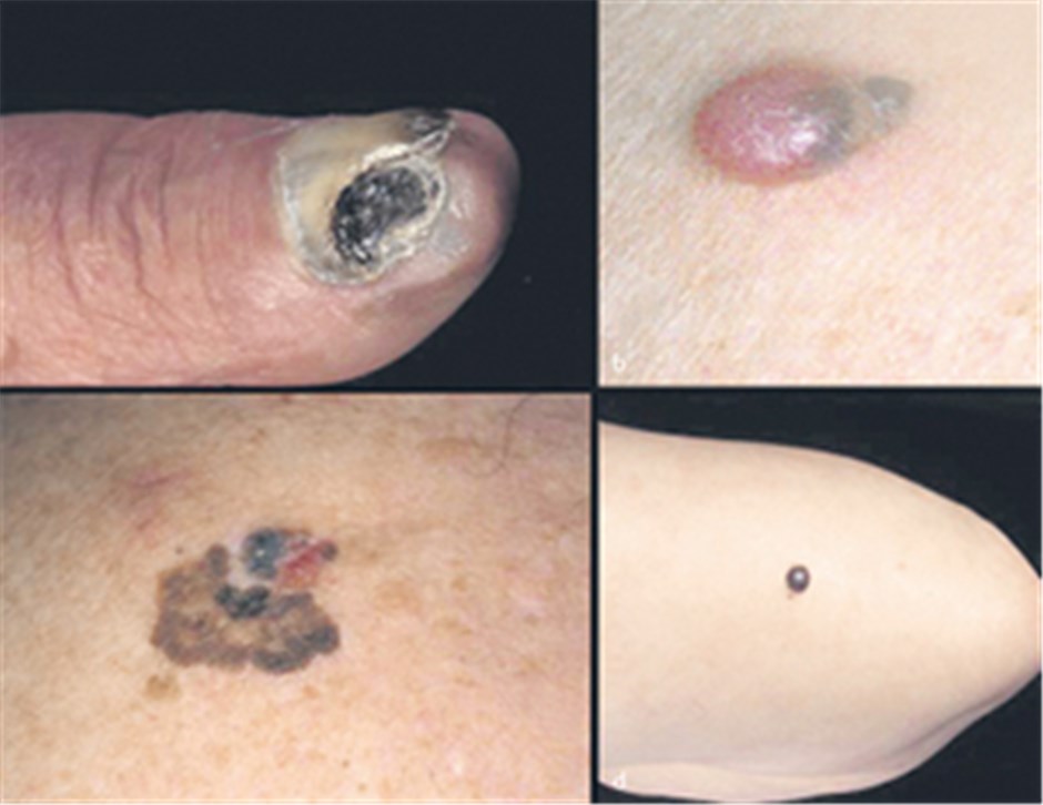 Hautkrebs? Bitte genau hingucken!