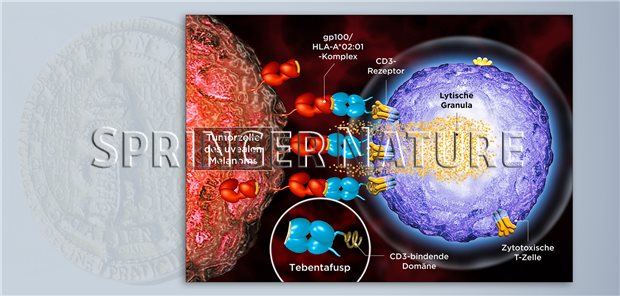Kimmtrak – die erste spezifische Therapieoption bei uvealem Melanom