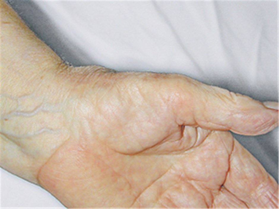 Delle im Daumenballen war Folge eines Karpaltunnelsyndroms