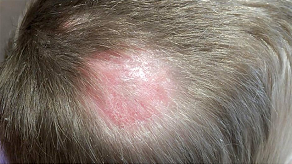 Dermatophytosen: Tipps für die Diagnostik und Behandlung