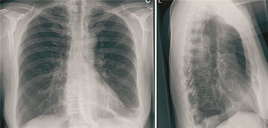 Seltene Ursache von Rippenschmerzen: Tumoren