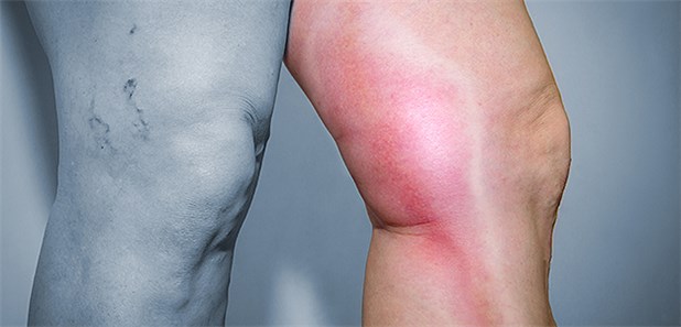 Hinter vielen Thrombosen steckt Krebs Hinter vielen Thrombosen steckt Krebs