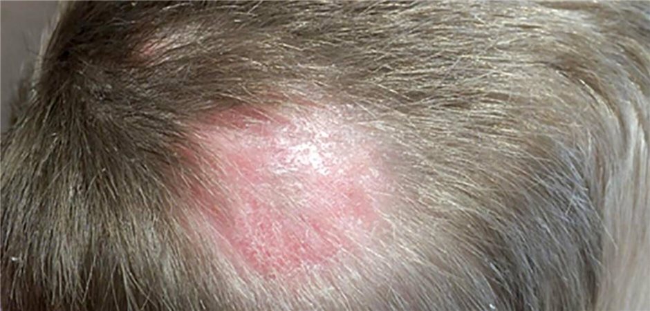 Tinea capitis: Von der Diagnose zur Therapie