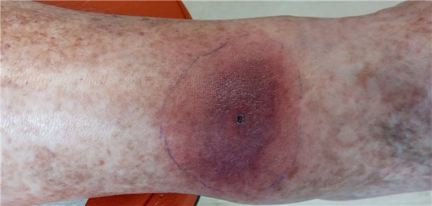 Das Einmaleins bei chronischen Wunden