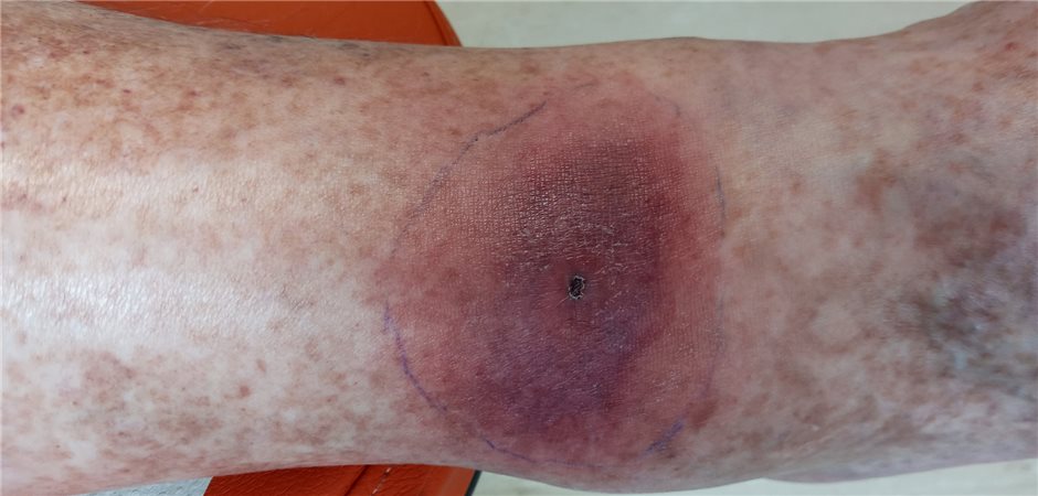 Das Einmaleins bei chronischen Wunden