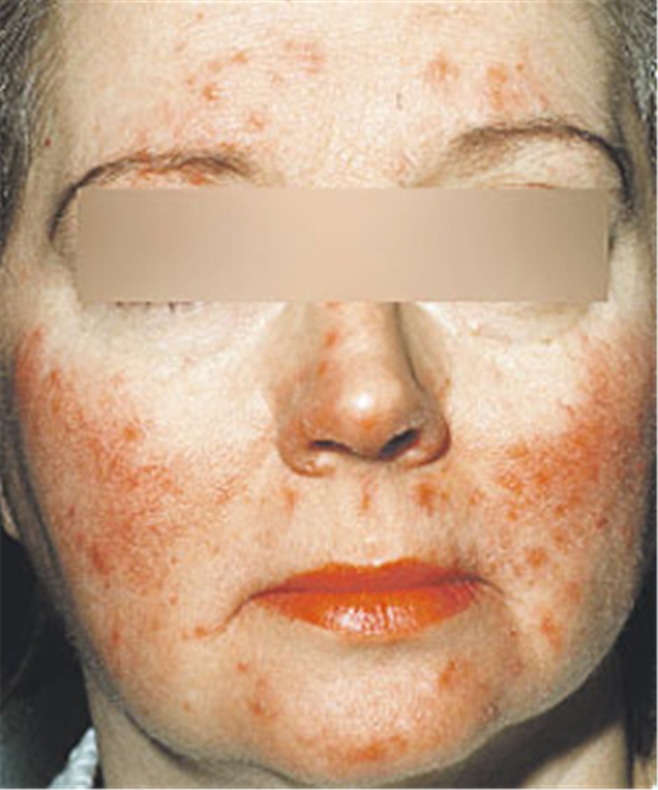 Anhaltende antientzündliche Therapie drängt Rosazea zurück